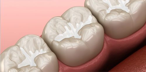 Fissure Sealants | Tooth Decay Treatment Near Me | Seven Sisters